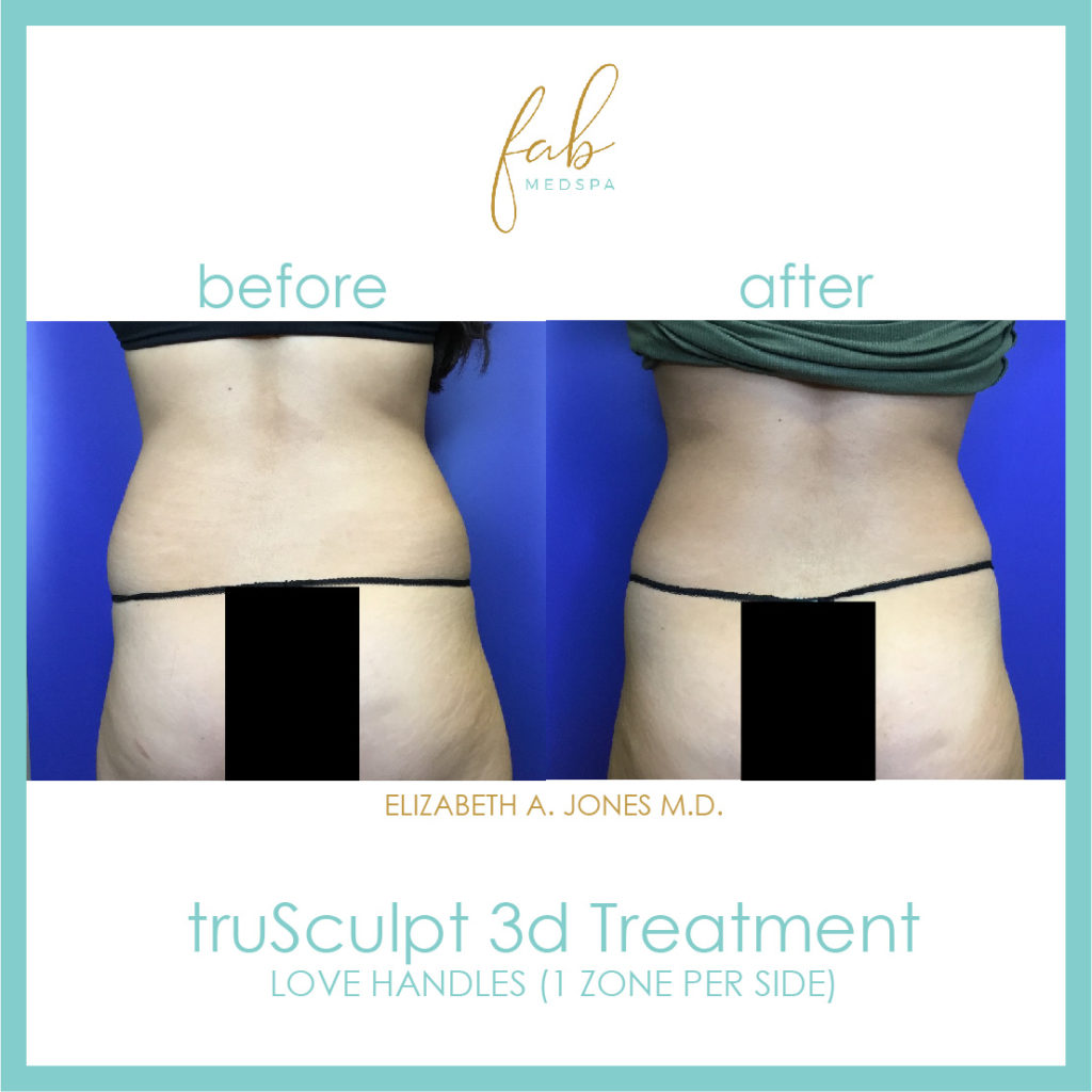 Trusculpt® 3d Body Sculpting Fab Med Spa